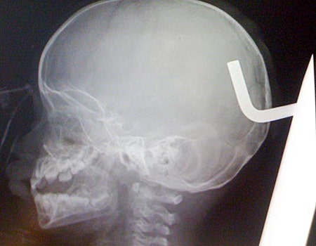 Toddler Released From Hospital After Metal Rod Impales Skull | Fox News