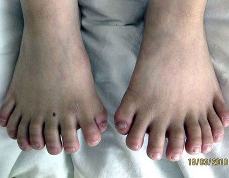 Boy With 31 Fingers, Toes Has Extra Digits Removed | Fox News