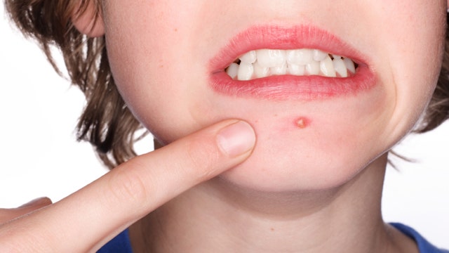 Why some people get zits and others don't | Fox News