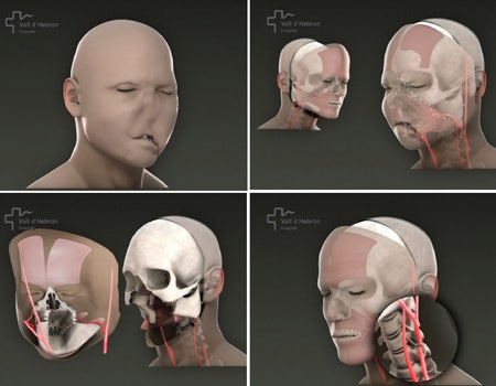 Spanish Hospital Claims 1st Full-Face Transplant | Fox News