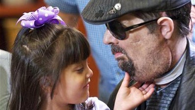 Face Transplant Recipient Embraces Life After Surgery | Fox News