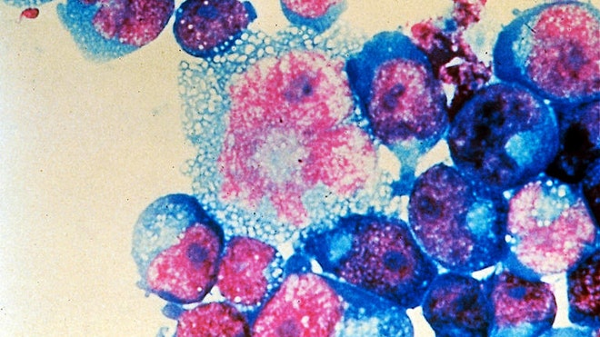 Aggressive form of HIV that quickly turns into full-blown AIDS found in ...