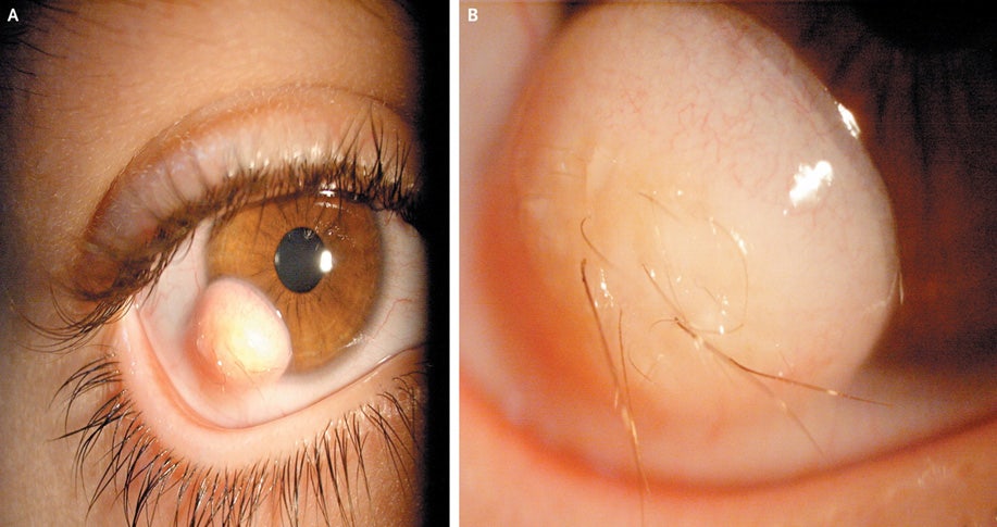 Rare tumor causes hair to grow on man's eyeball | Fox News