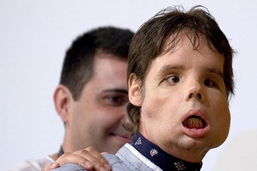 World's First Full Face Transplant Patient | Fox News