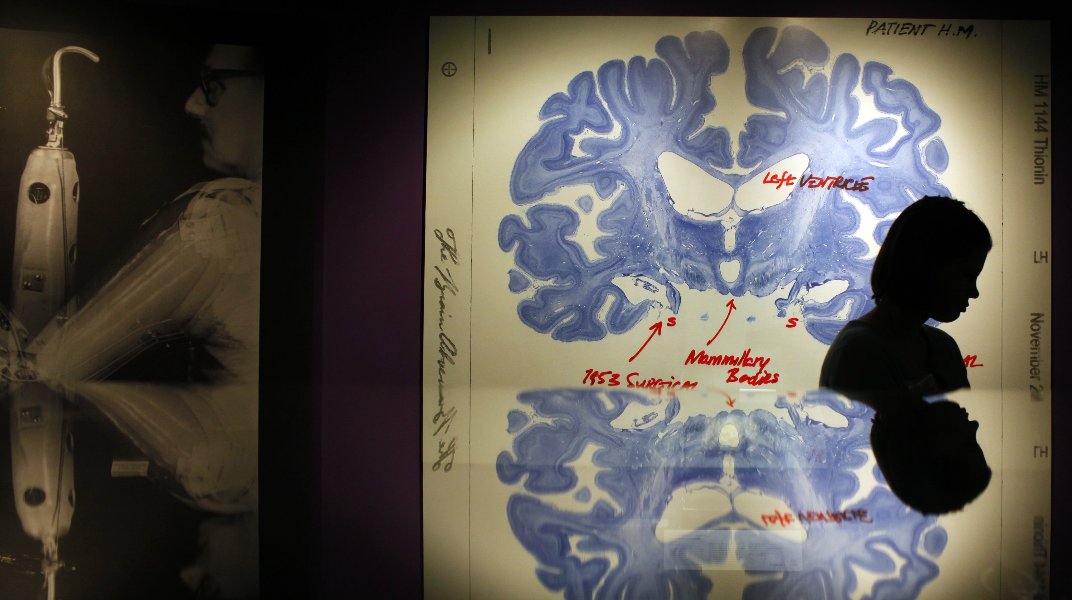 Famous amnesia patient's brain cut into 2,401 slices | Fox News