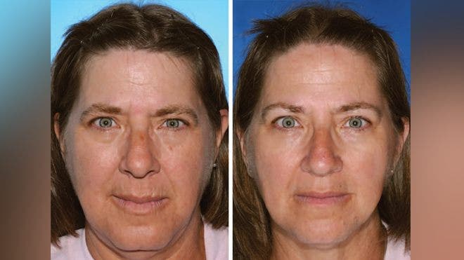 Smokers' skin may age faster, study of twins shows | Fox News