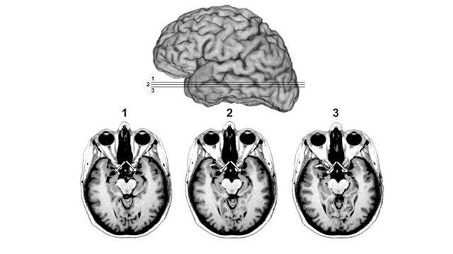 Spiders, Snakes? Brain-Damaged Woman Knows No Fear | Fox News