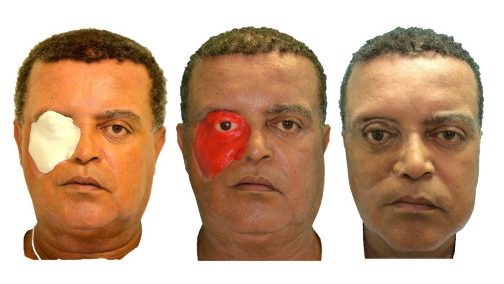 Cancer survivor receives world's first 3-D printed face prosthesis ...
