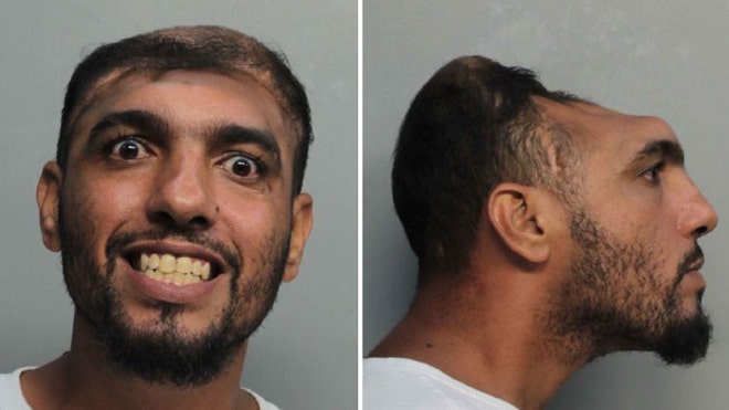 Miami man with half a head faces attempted murder and arson charges ...