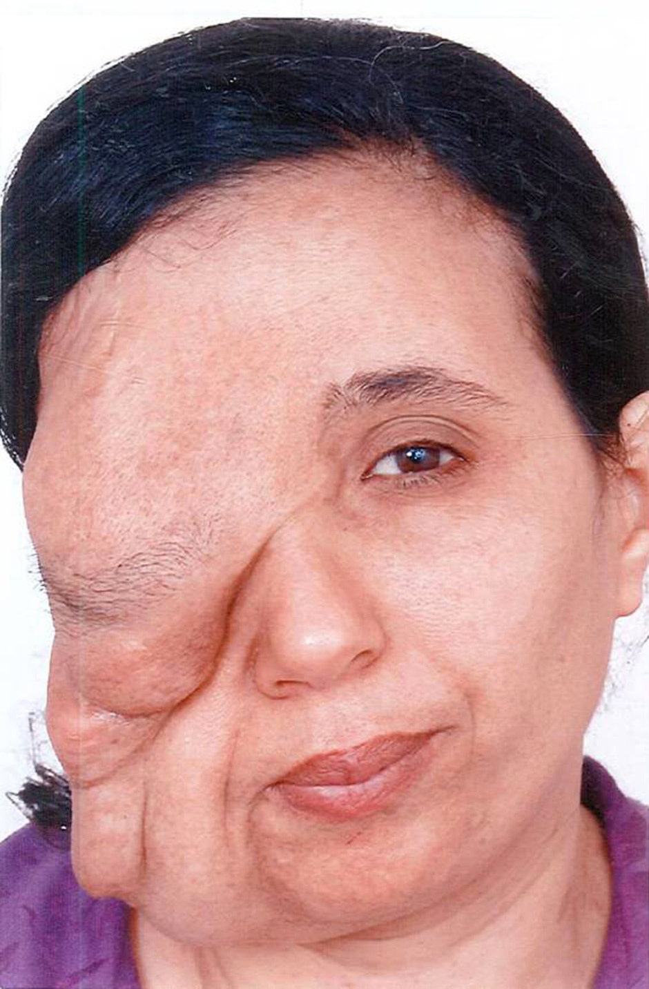 Moroccan woman with facial tumor gets life-changing reconstructive ...