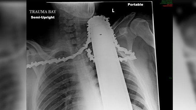 Chainsaw in the neck: How surgeons saved one man from a traumatic ...
