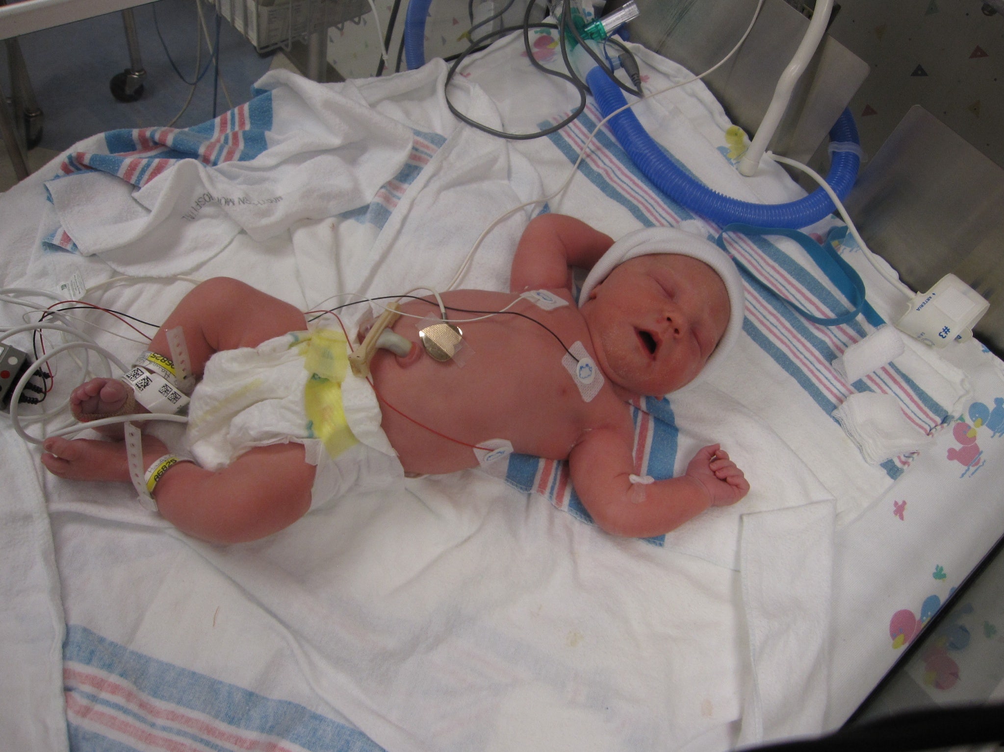 Blood transfusions during pregnancy save critically ill babies | Fox News