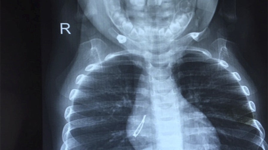 Doctors discover small light bulb inside a child after coughing fit ...