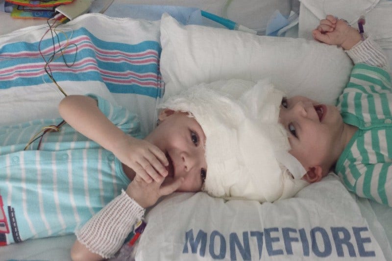 Illinois twins conjoined at the head undergo successful separation ...