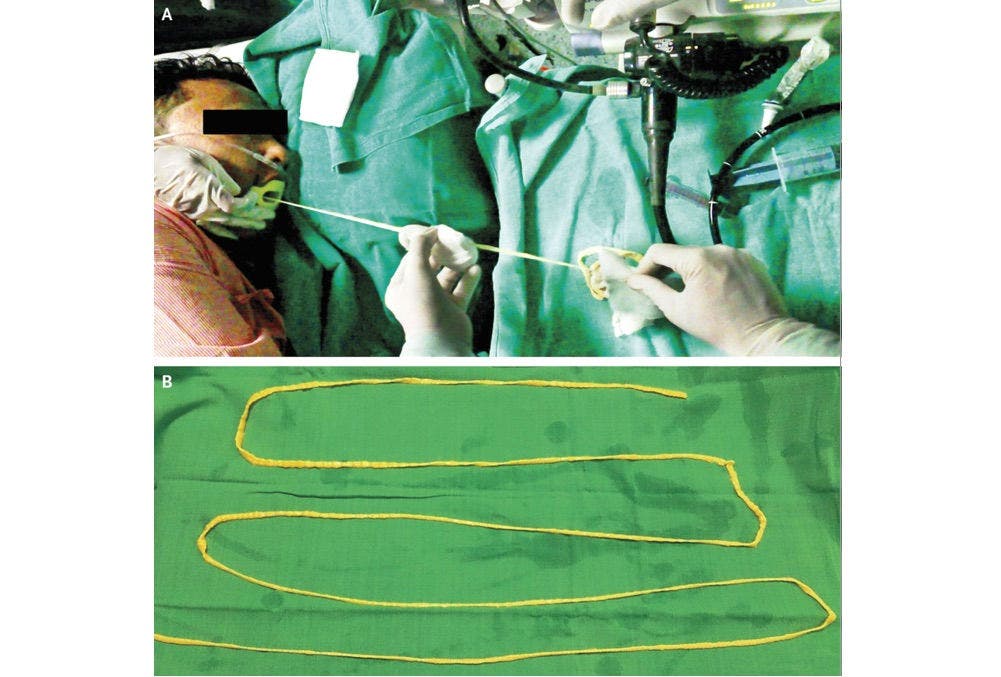 Doctors remove 6-foot-long tapeworm from man's gut | Fox News