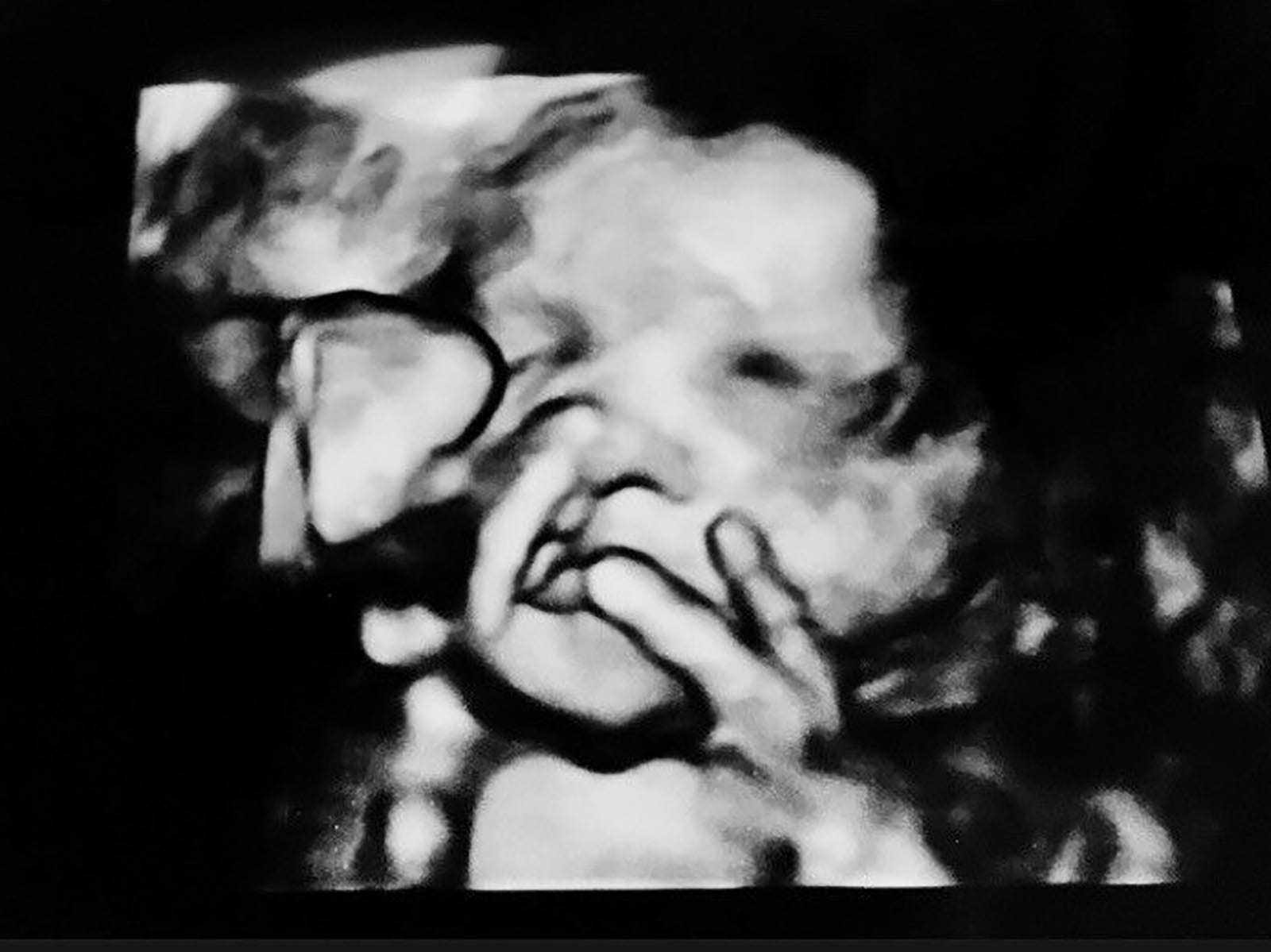 Parents say amazing ultrasound shows unborn baby giving V-sign | Fox News