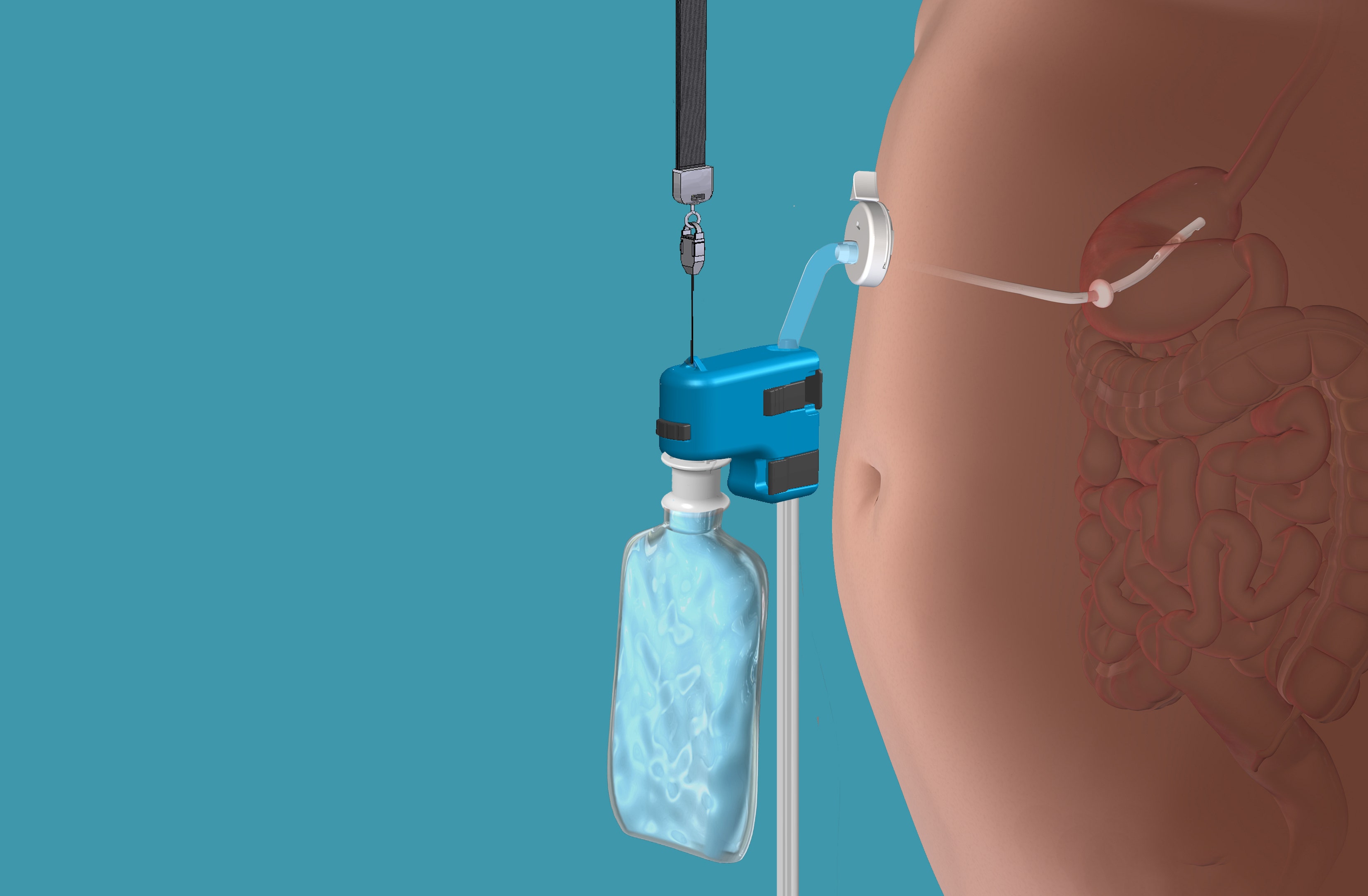 FDA approves stomach-draining obesity treatment | Fox News