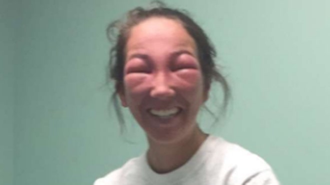 Photos of Connecticut woman with poison ivy in her eyes go viral | Fox News
