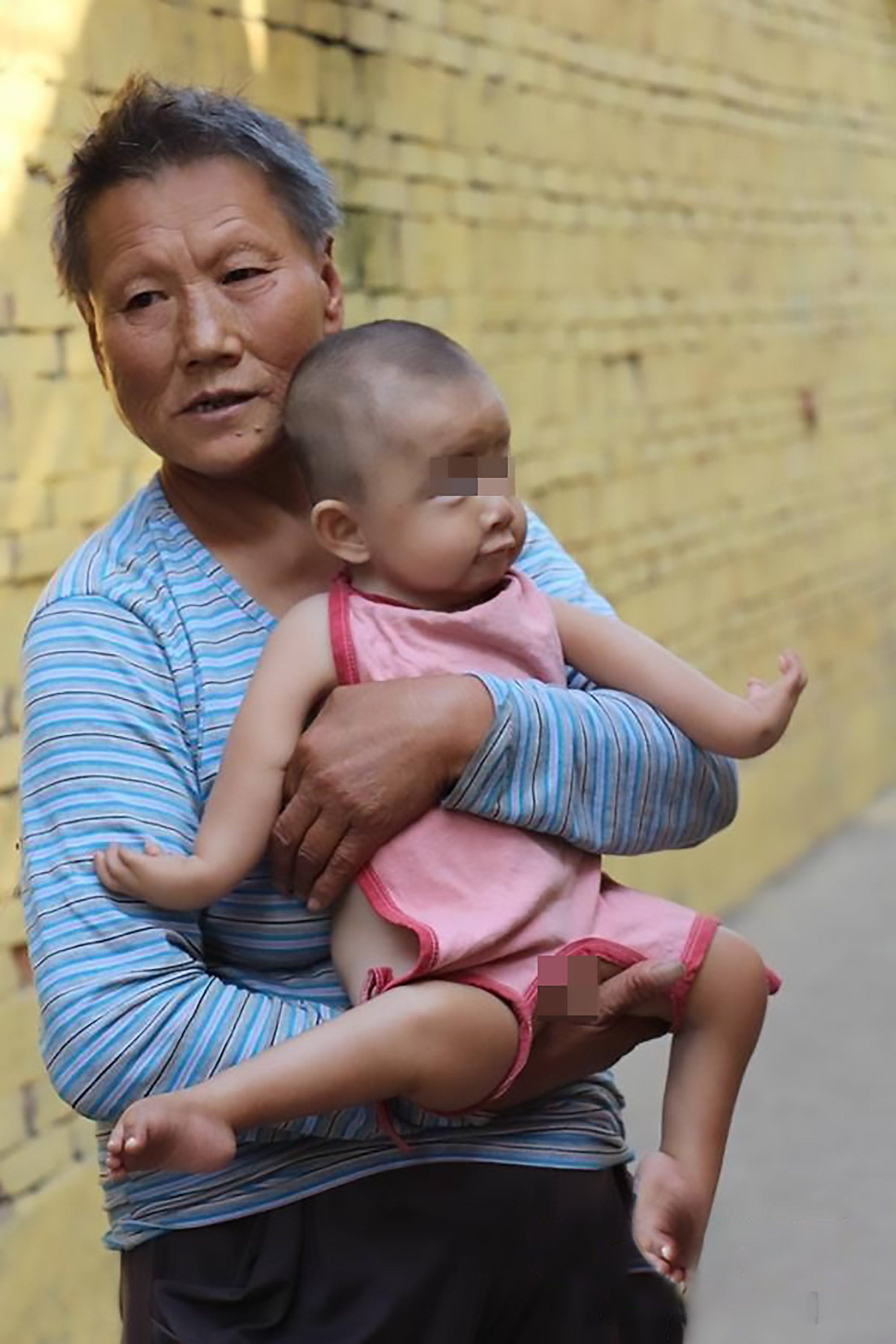 Parents abandon baby born with reverse limbs | Fox News