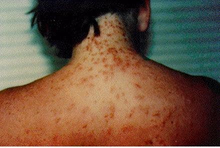 Florida Panhandle beachgoers warned of stinging sea lice | Fox News