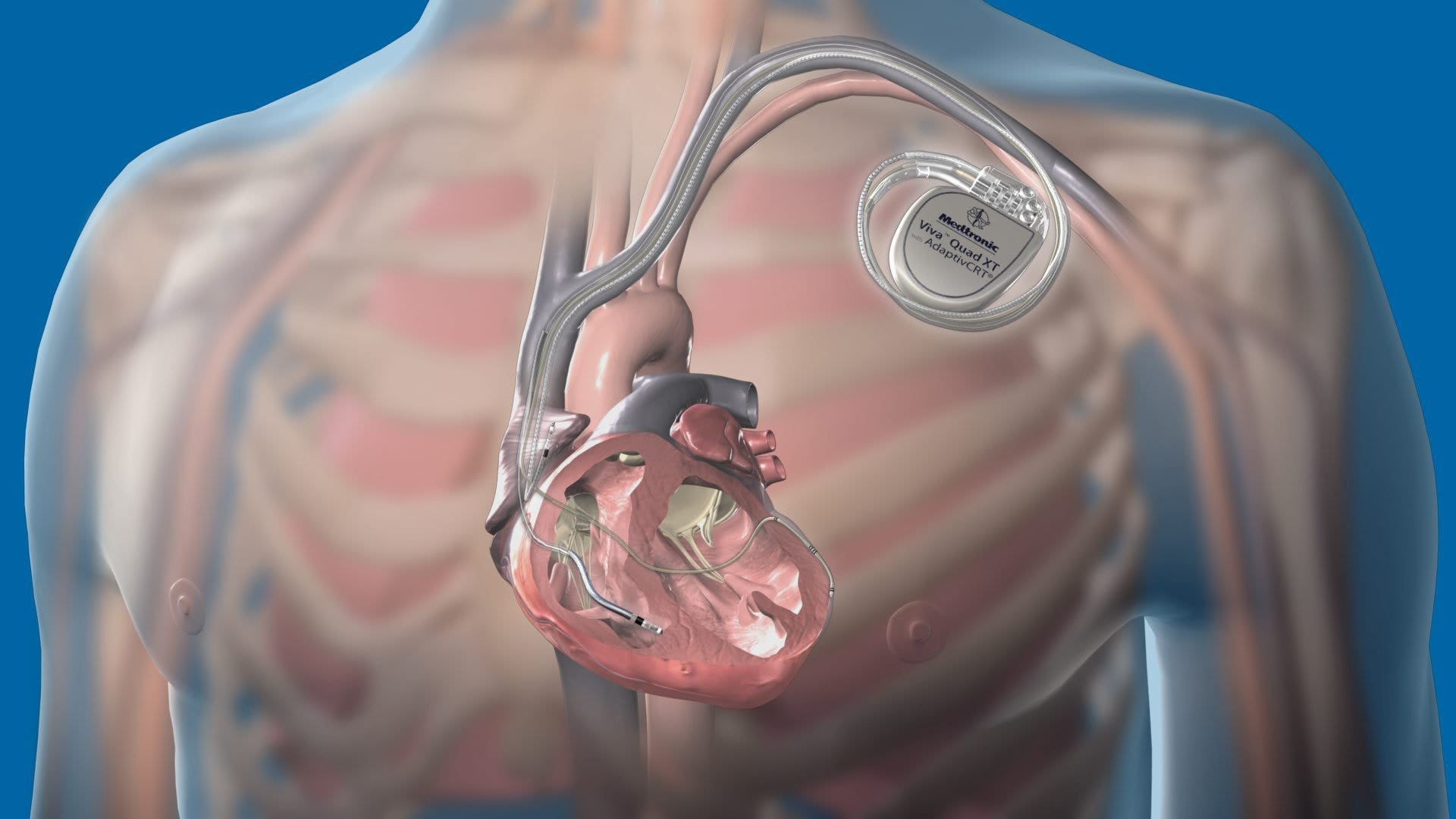 Heart alert: Pacemakers can be hacked, new research shows | Fox News