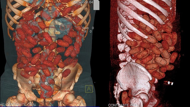Irish Man Reportedly Caught With 72 Cocaine Capsules in Stomach | Fox News