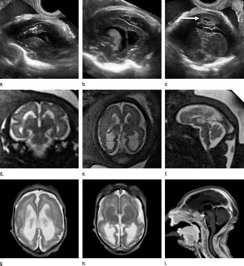 New images detail how Zika attacks developing brains | Fox News